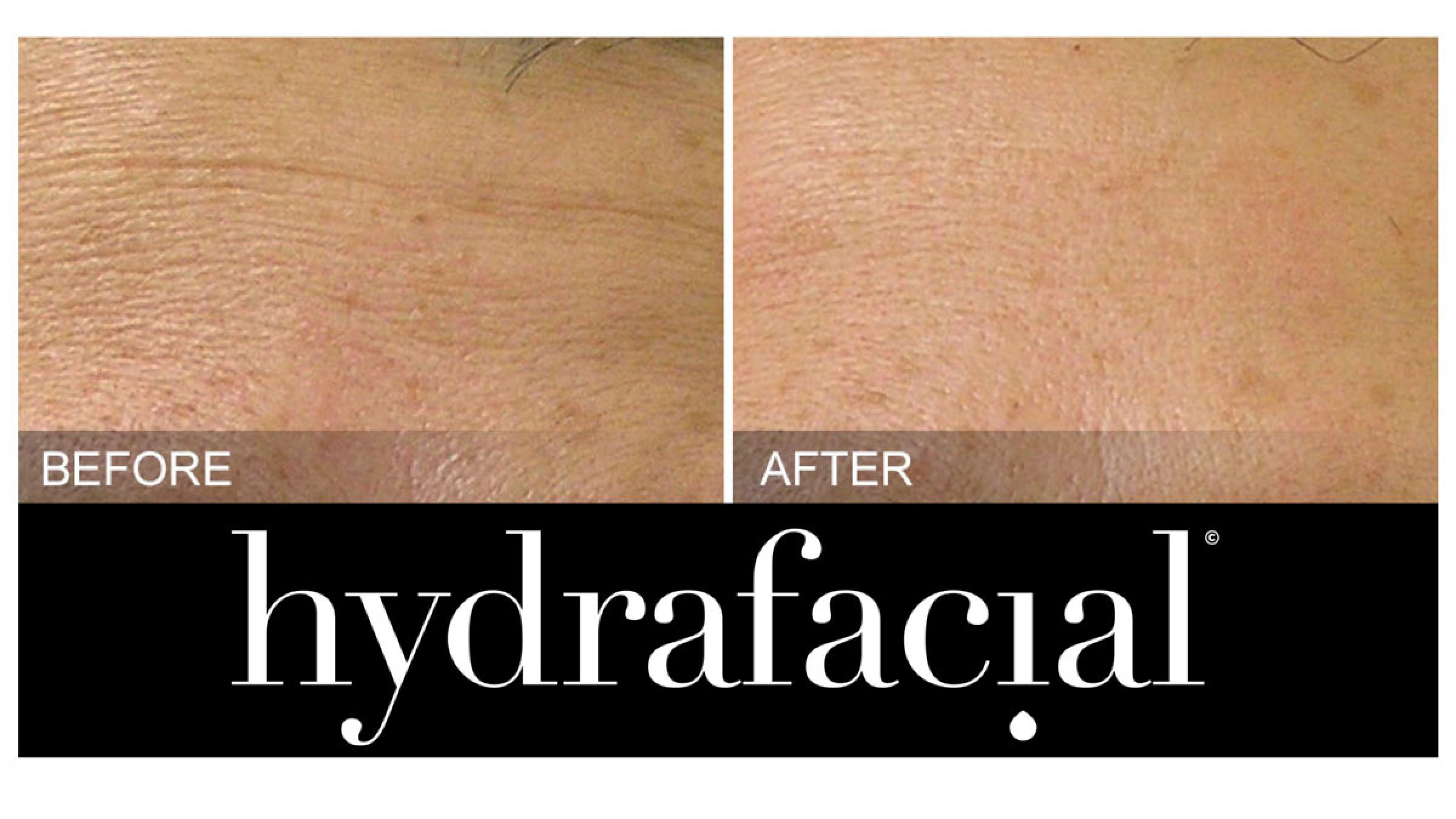 HydraFacial – Ines Kosmetik & more